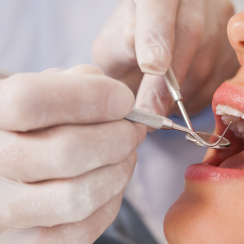Caseum amigdalar: causas, síntomas y tratamiento | Dentinos