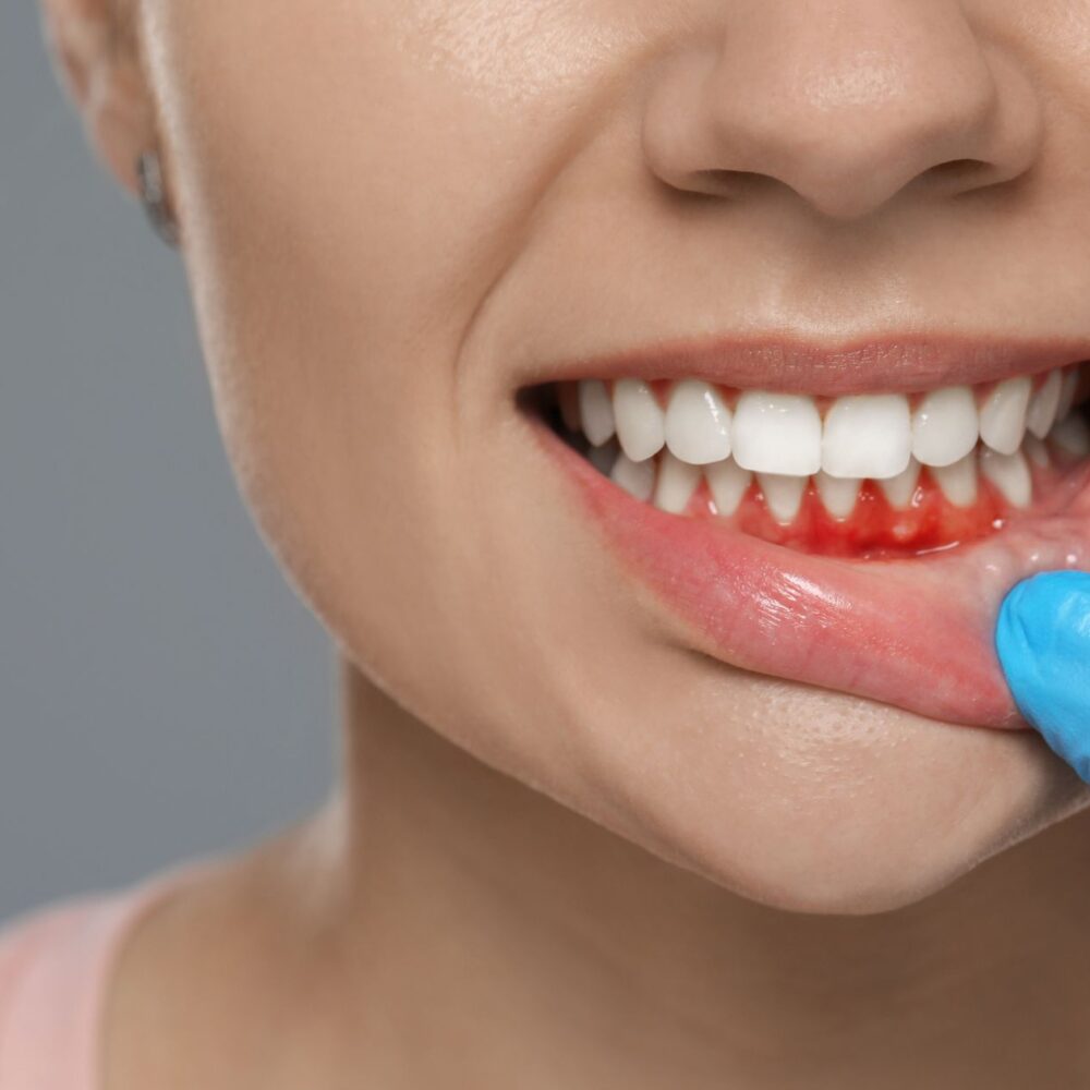 Caseum amigdalar: causas, síntomas y tratamiento | Dentinos