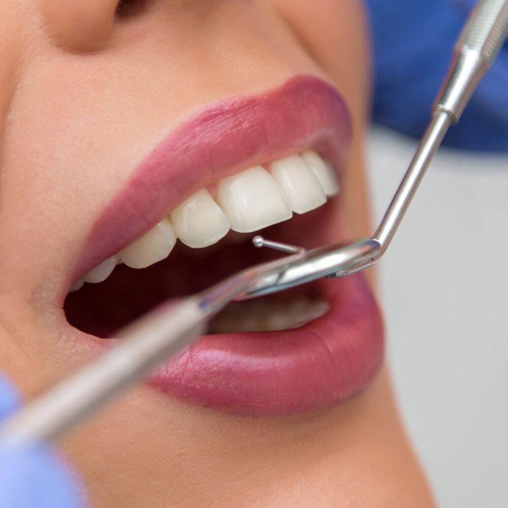 Caseum amigdalar: causas, síntomas y tratamiento | Dentinos