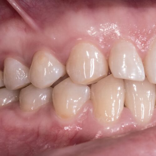 Caseum amigdalar: causas, síntomas y tratamiento | Dentinos