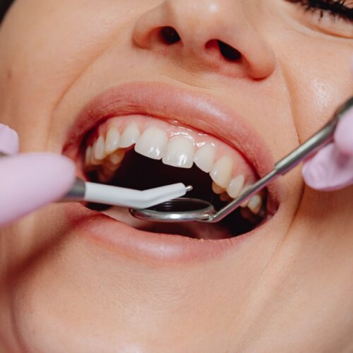 Caseum amigdalar: causas, síntomas y tratamiento | Dentinos