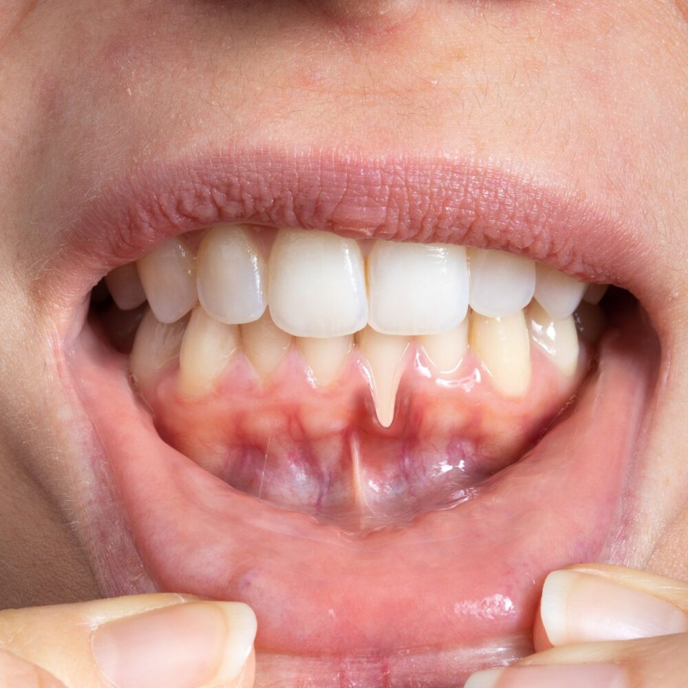 Caseum amigdalar: causas, síntomas y tratamiento | Dentinos